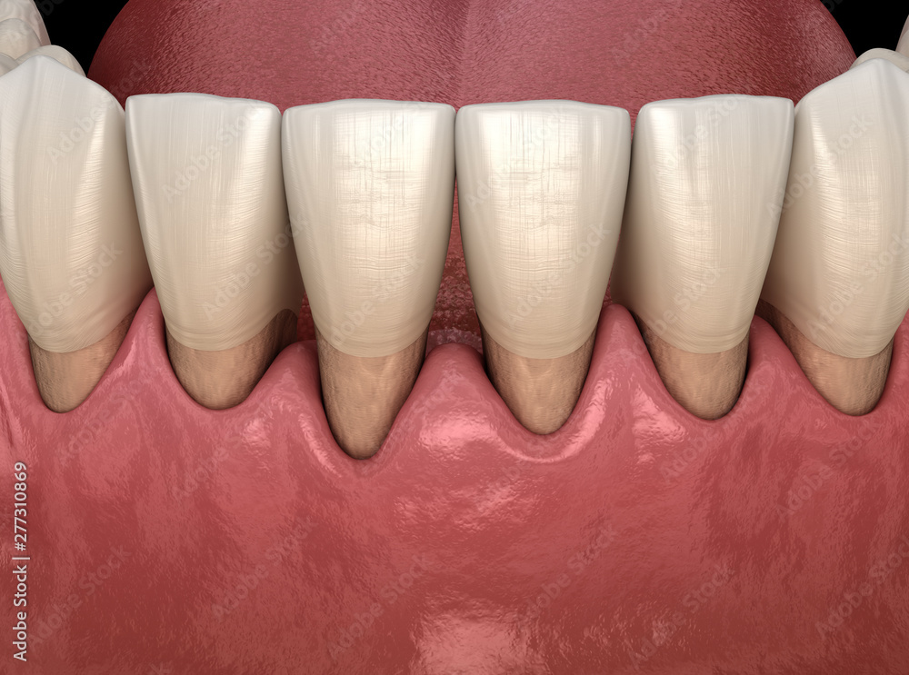 Gum recession process. Medically accurate 3D illustration Stock Photo ...