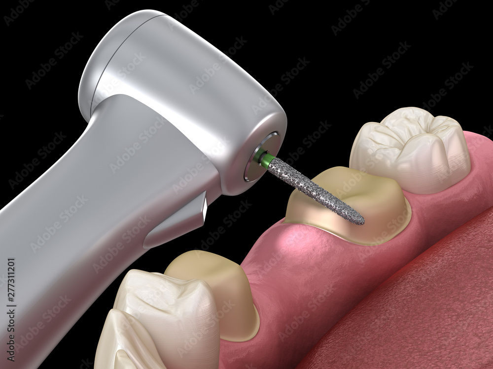 Premolar preparation process for dental crown placement. Medically ...