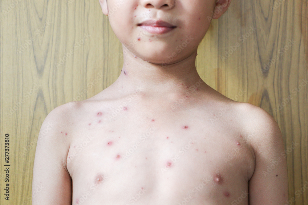 Chicken pox rash on young boy body.Chickenpox is an infection caused by ...