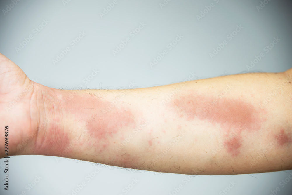 Man getting red skin rash at his body part - people with skin allergy ...