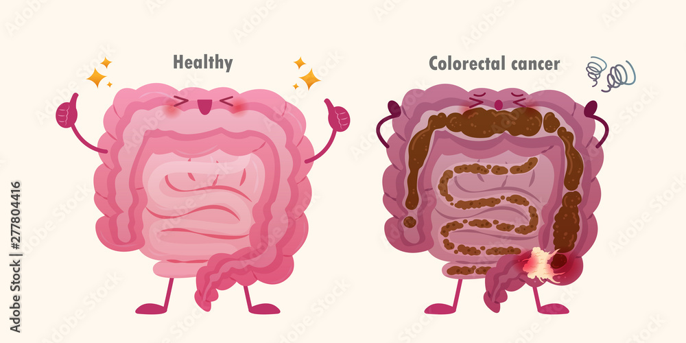 colorectal cancer issue Stock Vector | Adobe Stock