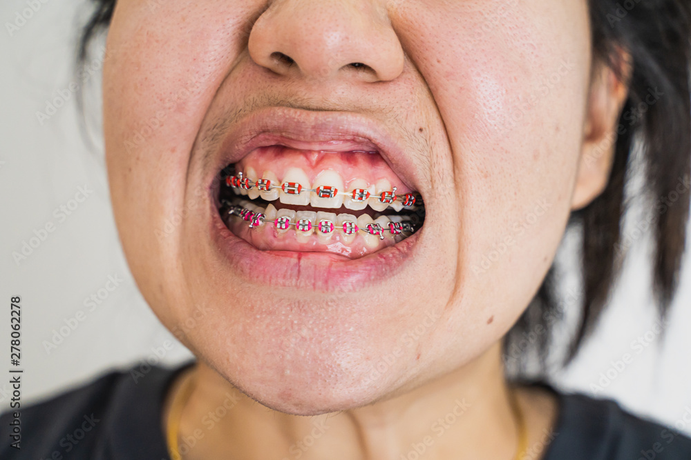 Asian women's teeth aged 25-30 years, not scale. Yellow teeth,Women ...