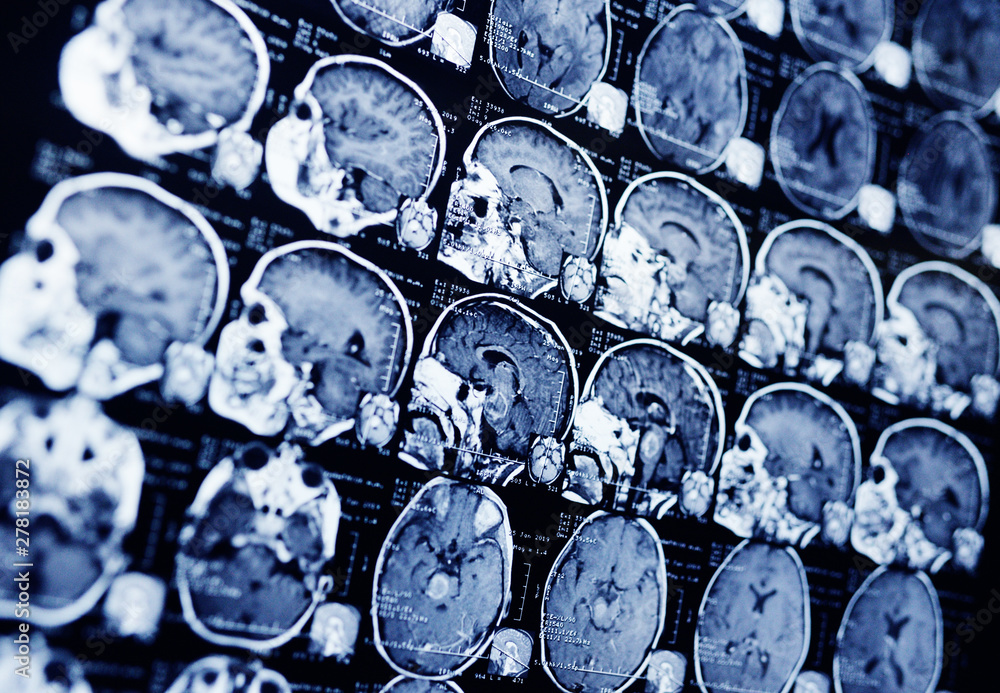 MRI scan of a patient with a tumor in the brain stem. Neurosurgery ...