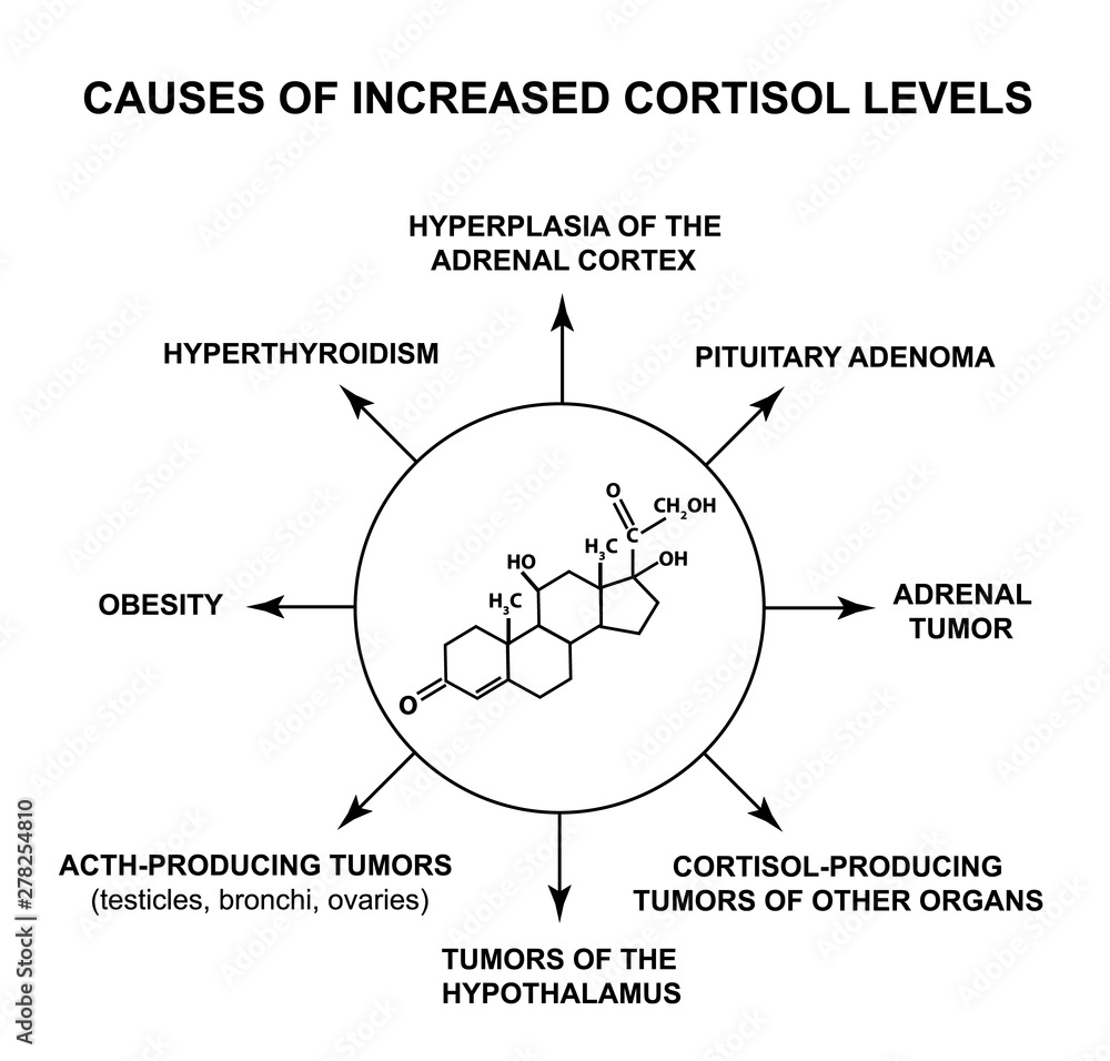 Vektorová grafika „Causes of increased cortisol levels. The stress ...