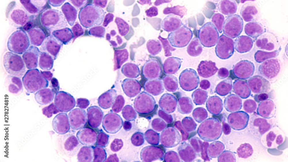 Leukemia Awareness: Photomicrograph of bone marrow aspirate showing ...
