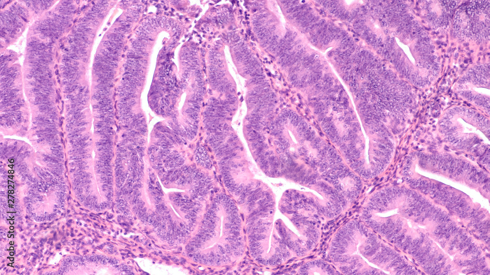 Plakat Microscopic image (photomicrograph) of complex endometrial ...