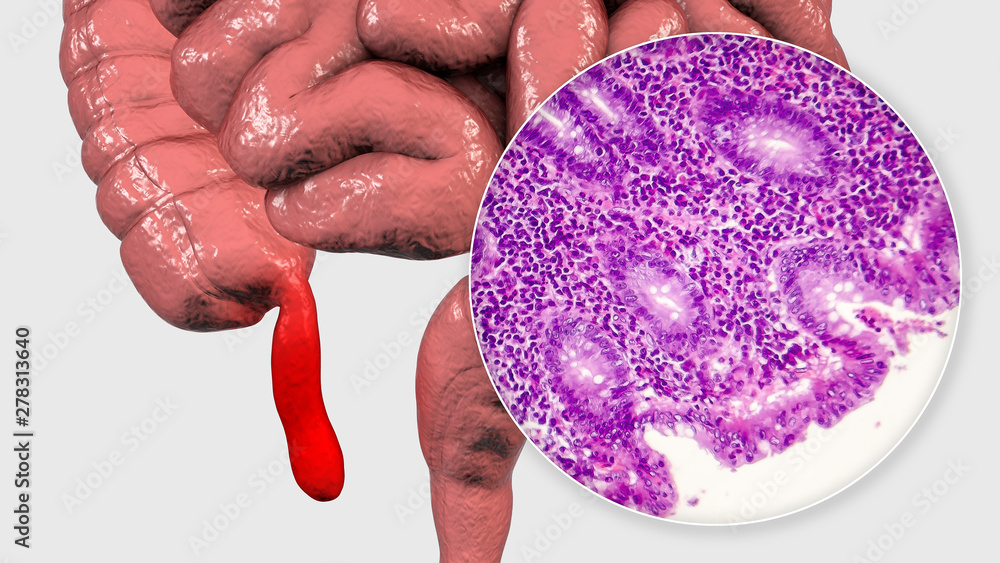 Acute suppurative appendicitis, 3D illustration of human intestine with ...