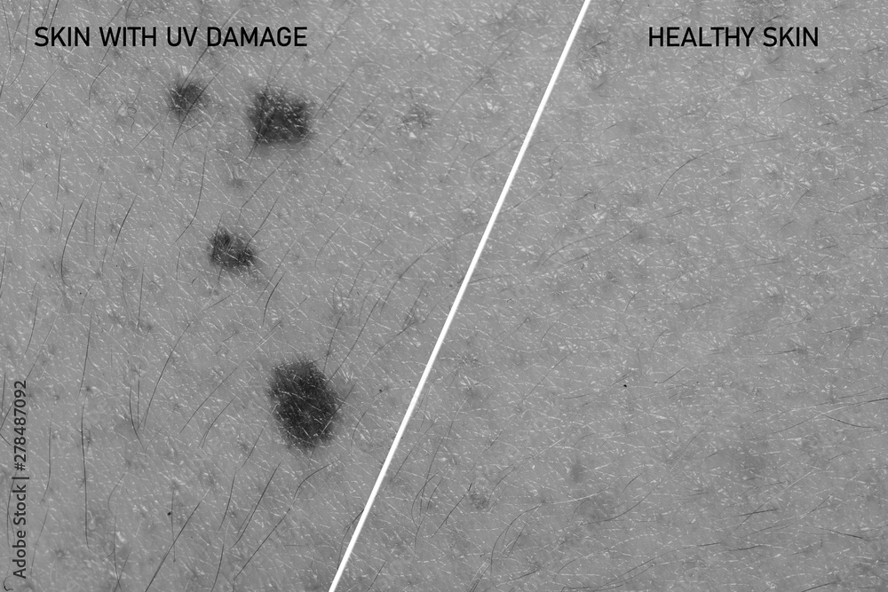 A side by side comparison of human skin with and without UV damage from ...
