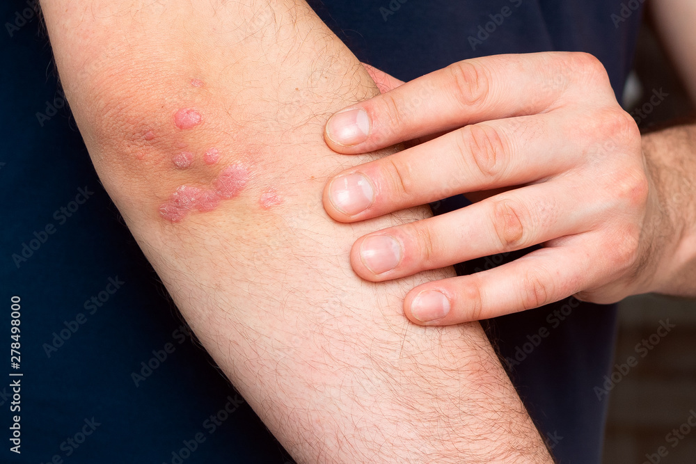 Psoriasis on the elbow. A man shows a focus of psoriasis on his body ...
