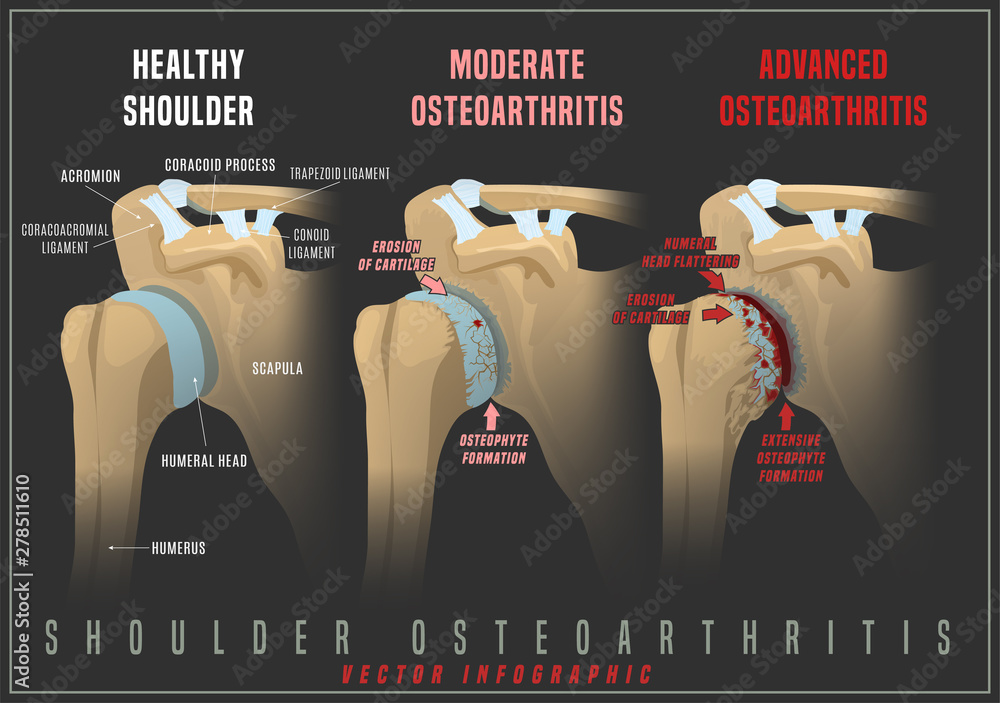 Shoulder osteoarthritis infographic Stock Vector | Adobe Stock