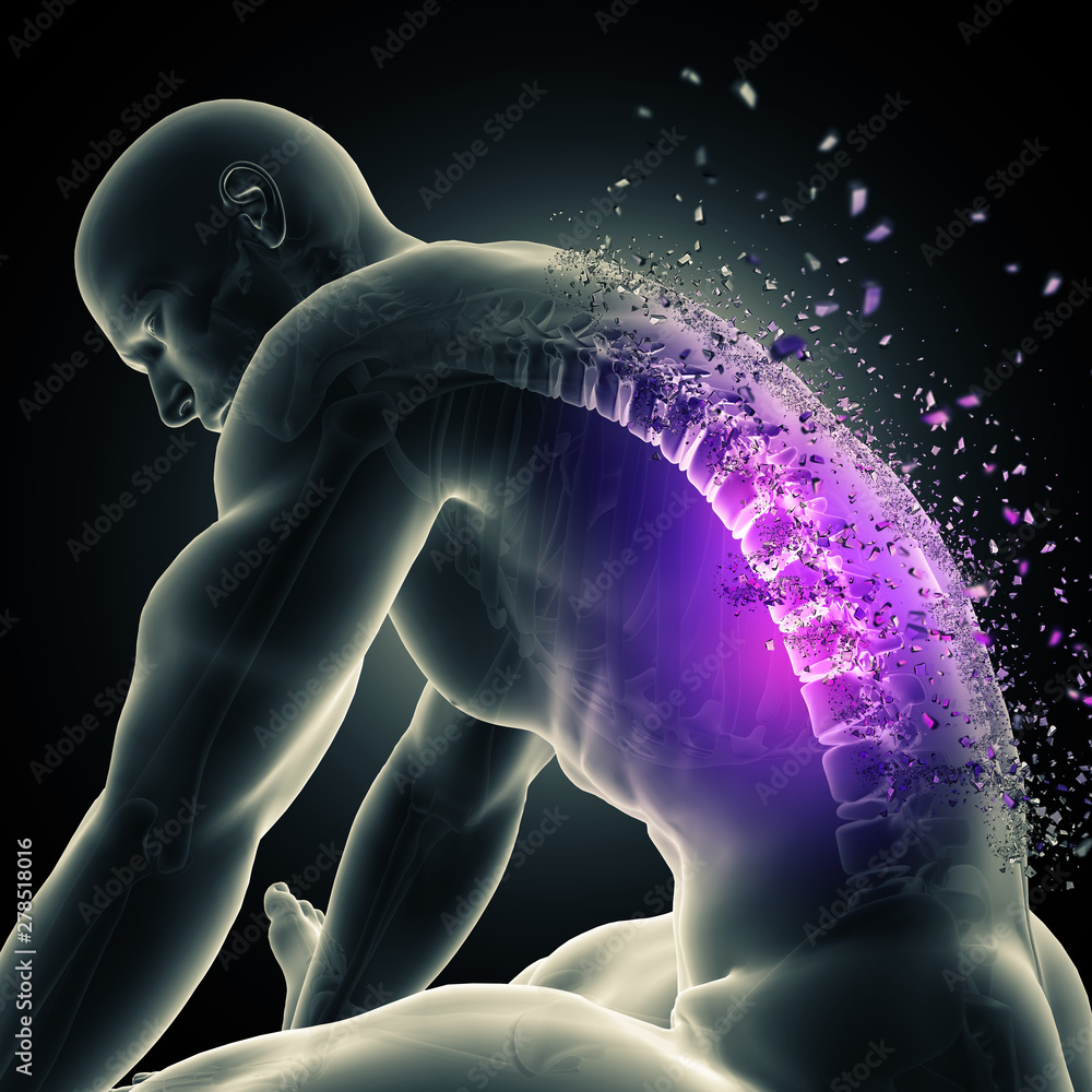 3D male figure leaning over with spine highlighted and shattering ...