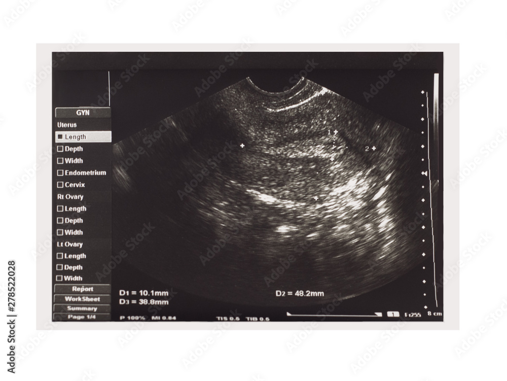 Ultrasound imaging of female uterus isolated on white background ...