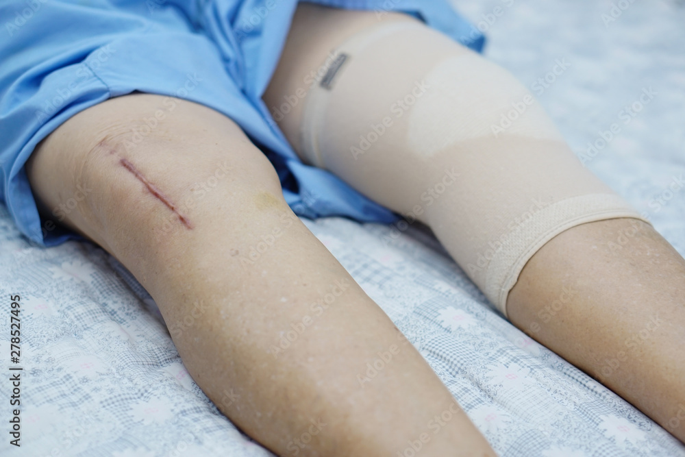 Asian elderly woman patient show her scars surgical total knee joint ...