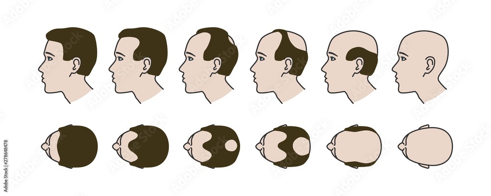 Stages of baldness, transplantation and hair extensions, treatment of ...