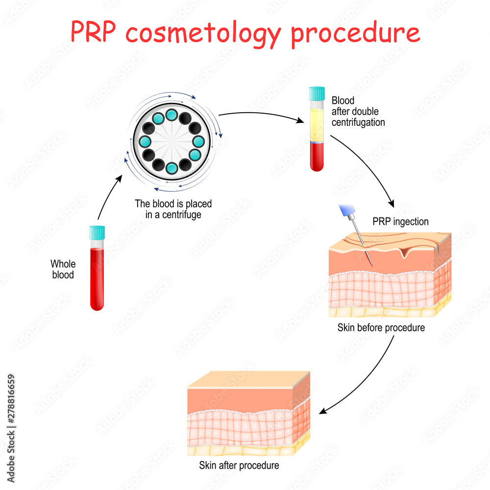 PRP cosmetology procedure. test tubes and syringe with blood and ...