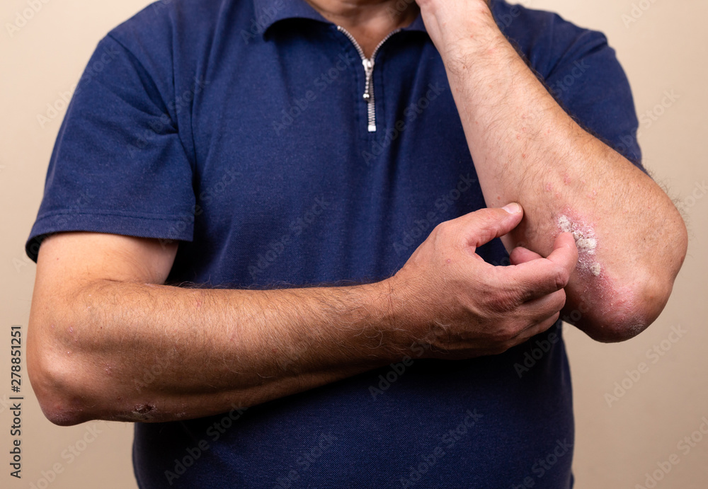 Close up dermatitis on skin, ill allergic rash dermatitis eczema of ...