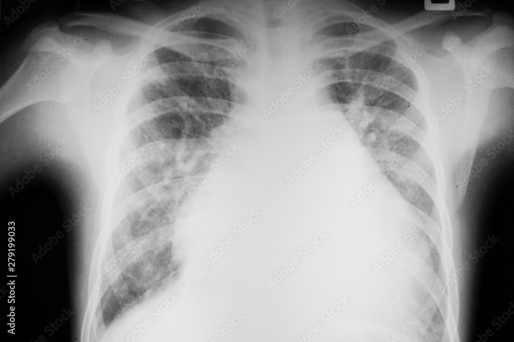Chest x-ray image of dextrocardia and situs inversus patient that ...