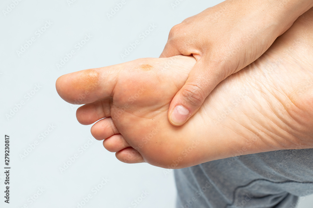 Female hand tightening its foot with calluses and warts Stock Photo ...
