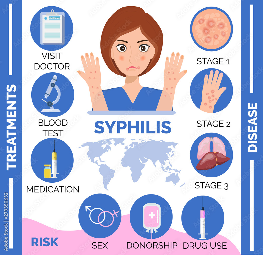 Vettoriale Stock Syphilis disease, consequences, stages infographic for ...