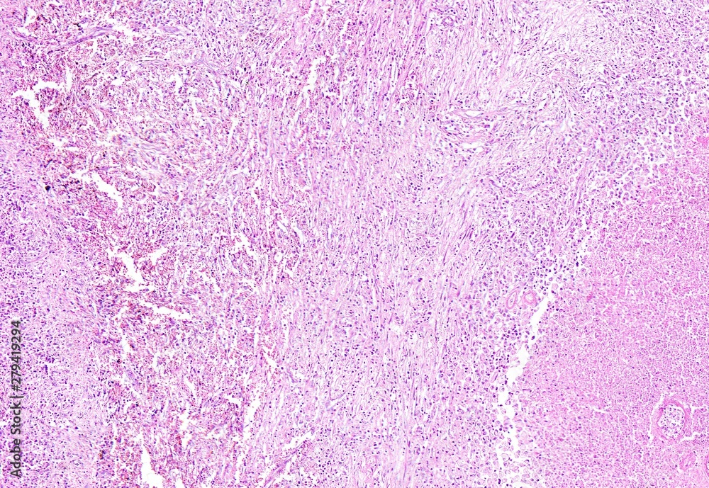 Histology of human tissue, show spleen infarction at a scarring stage ...
