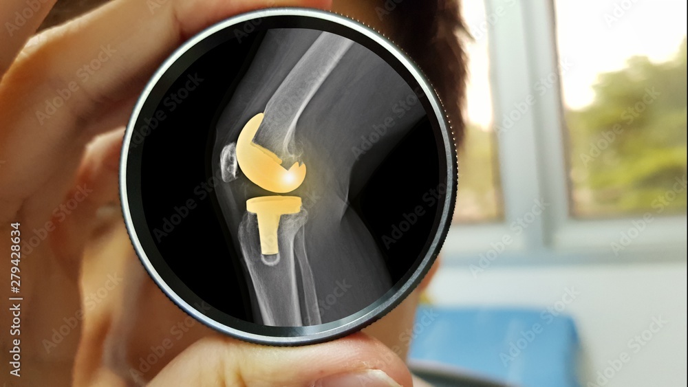 Orthopedic doctor‘s hand holding magnified lens and the reflex of lens ...