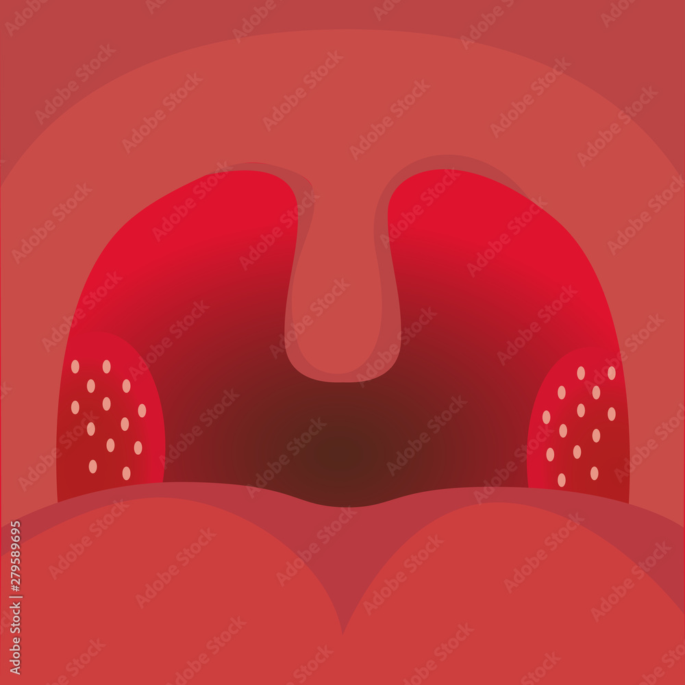 Tonsilitis, sore throat vector illustration Stock Vector | Adobe Stock