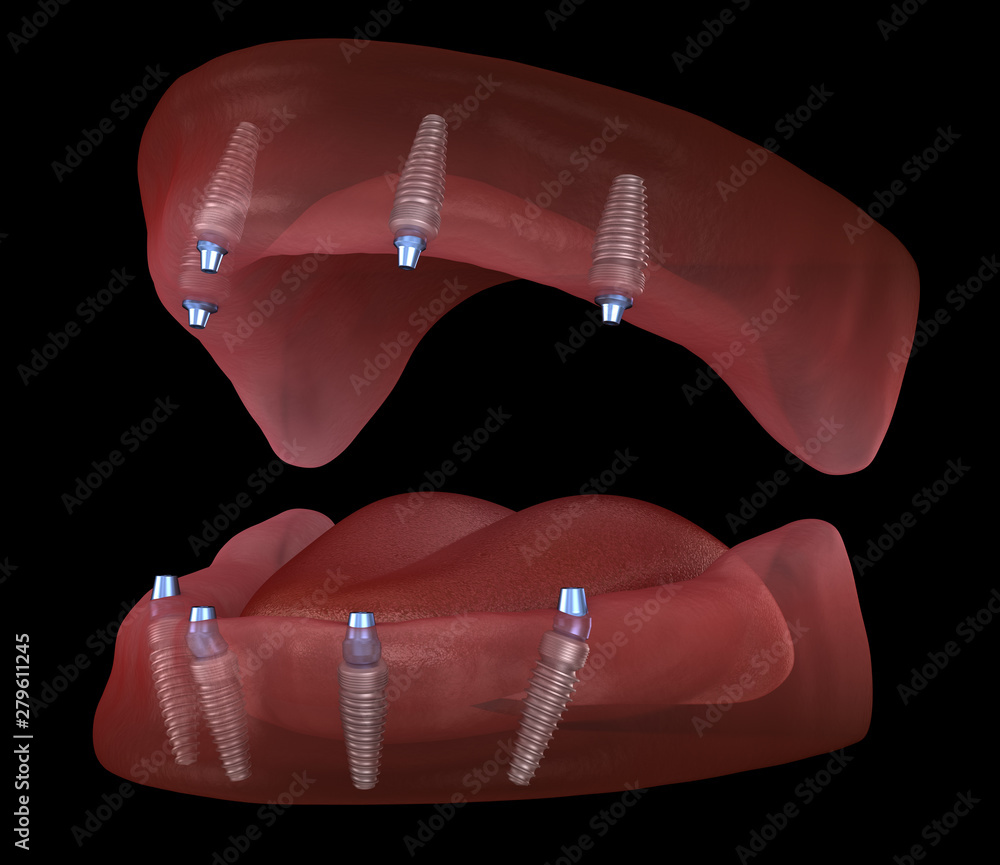 Maxillary and Mandibular prosthesis with gum All on 4 system supported ...