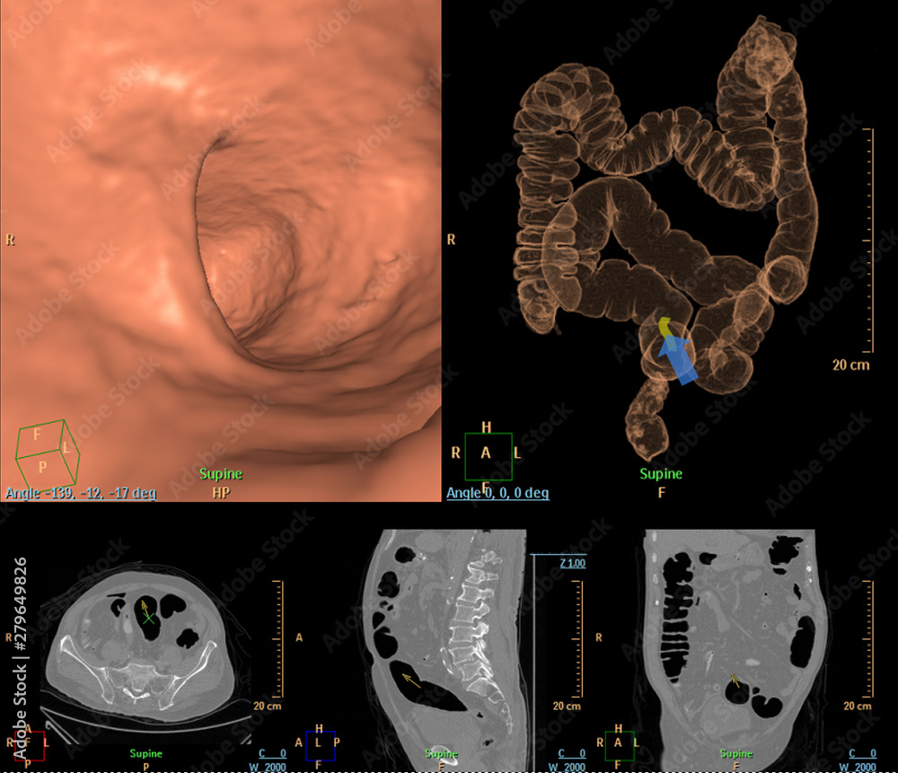 CT colonography compare 2D Axial,sagittal ,coronal plane and 3D ...