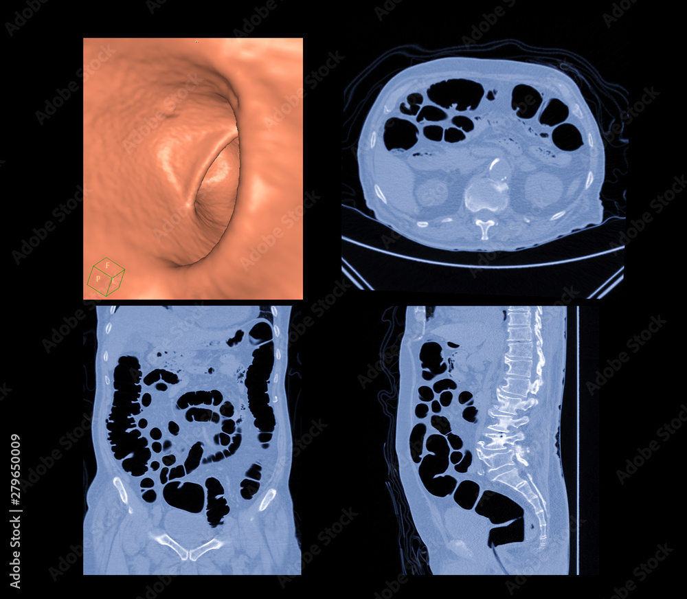 CT colonography compare 3D and 2D Axial,sagittal ,coronal plane for ...
