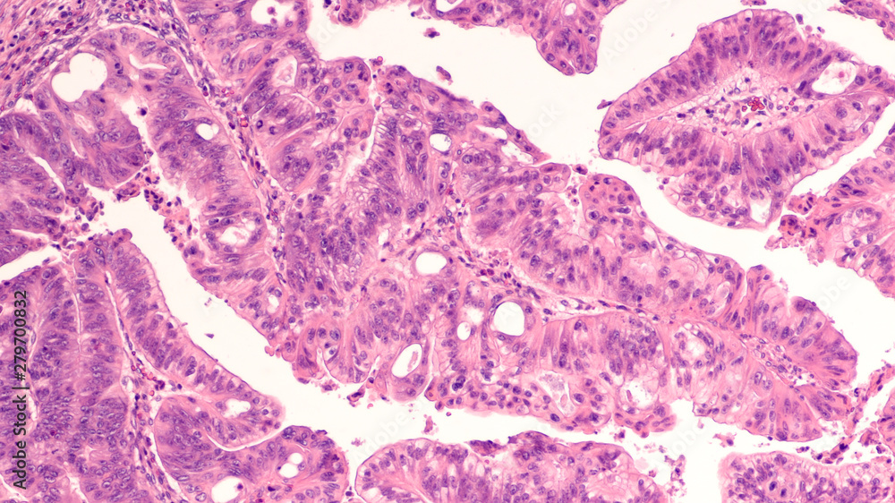 Fotografia do Stock: Colon Cancer: Photomicrograph (microscopic image ...