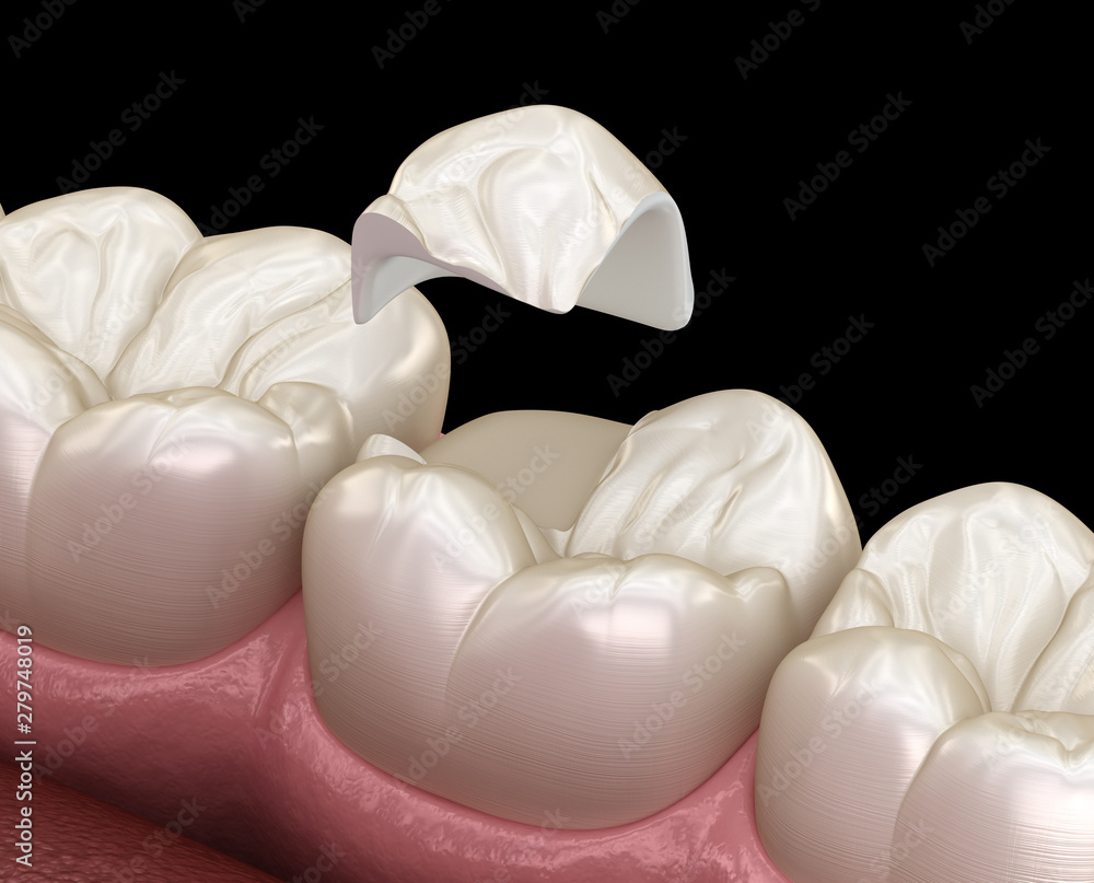 Onlay ceramic crown fixation over tooth. Medically accurate 3D ...