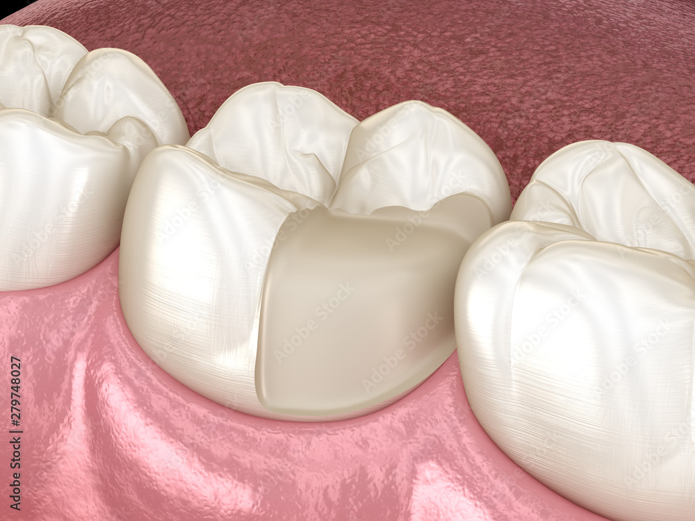 Onlay ceramic crown fixation over tooth. Medically accurate 3D ...