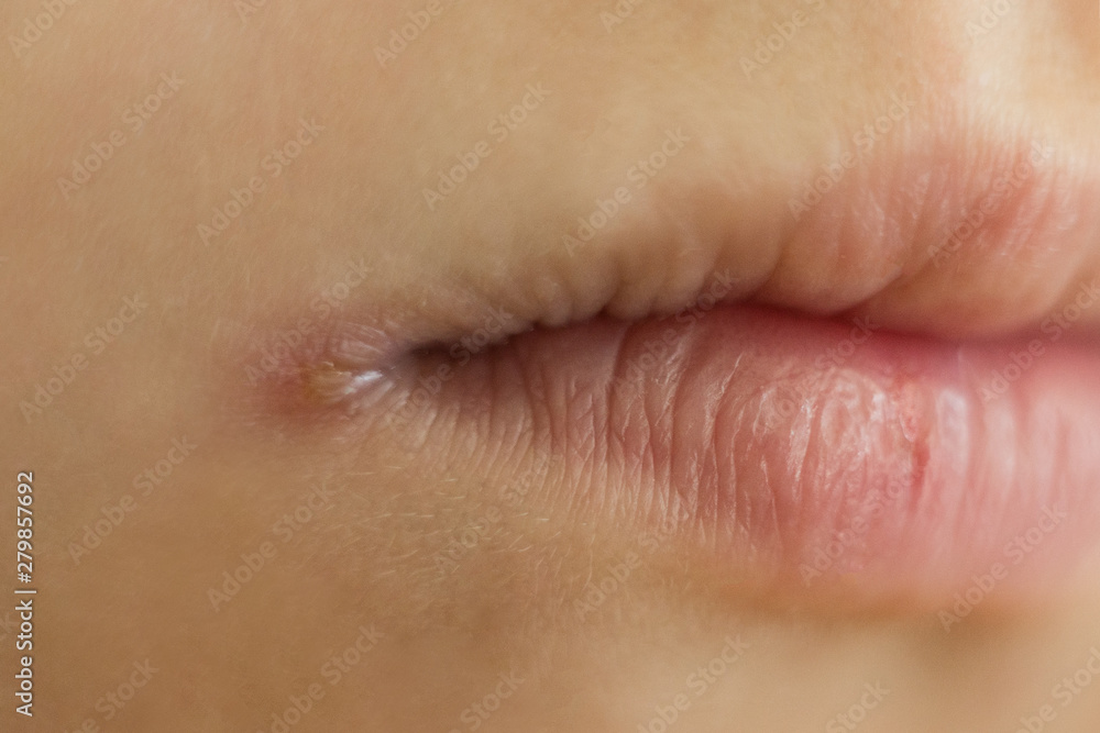 Foto de skin problems, angulitis, angular stomatitis, angular cheilitis ...