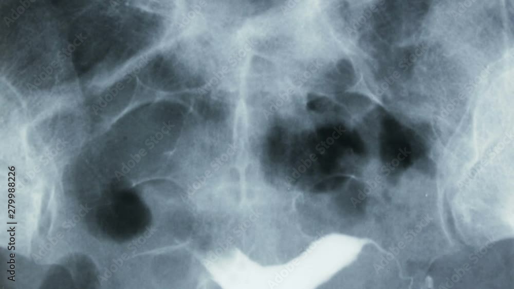 Vertical tracking of a radiograph of the pelvis and of the human ...