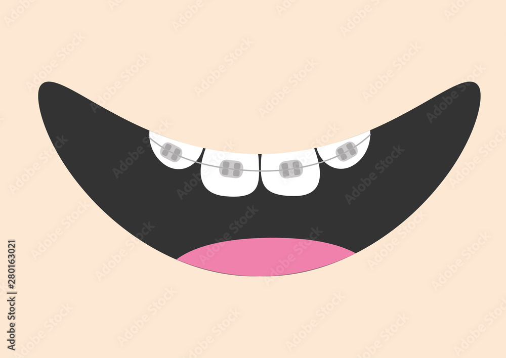 Mouth with tooth braces and tongue. Smiling face. Healthy teeth brace ...