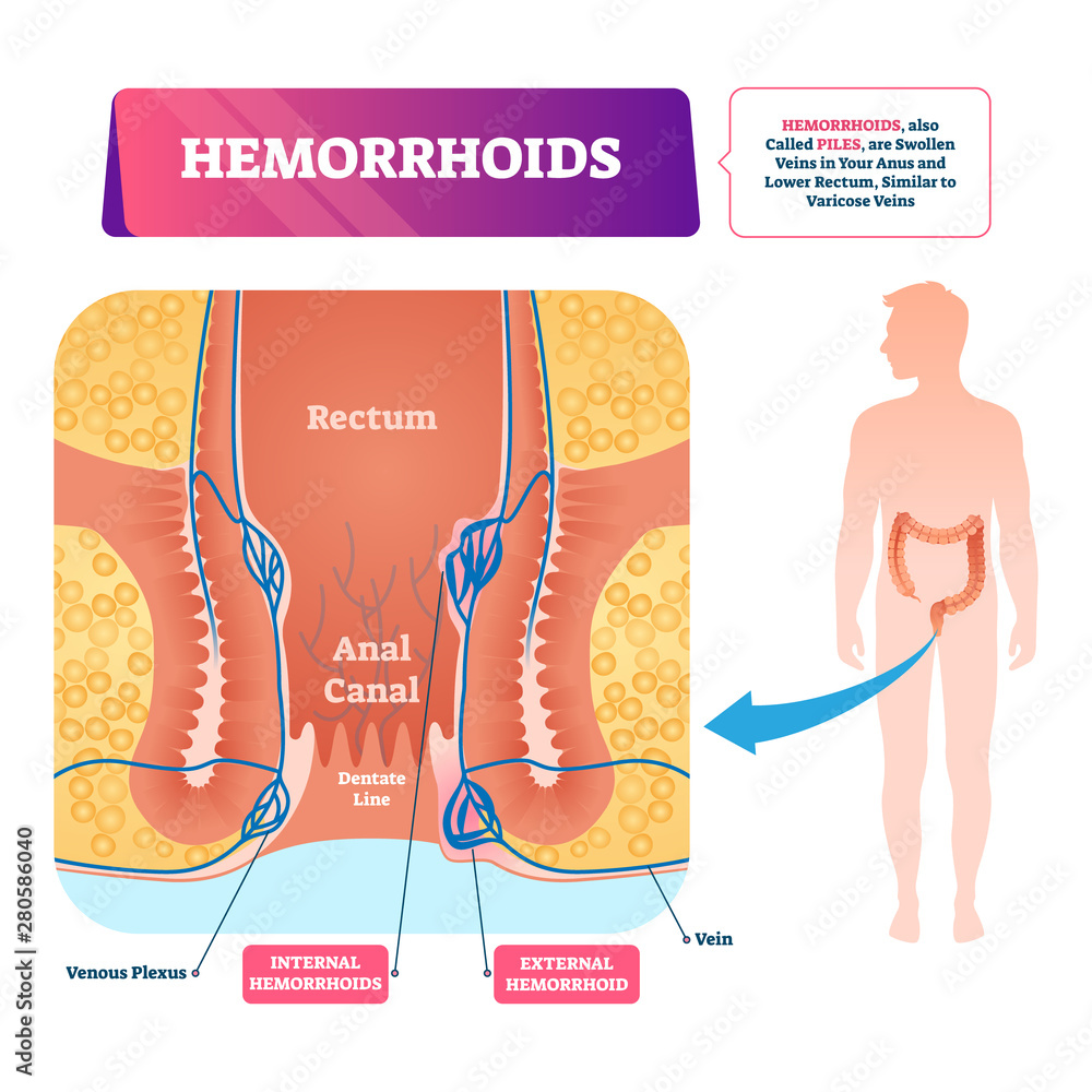 Hemorrhoids vector illustration. Labeled anatomical vascular piles scheme. Stock Vector | Adobe ...