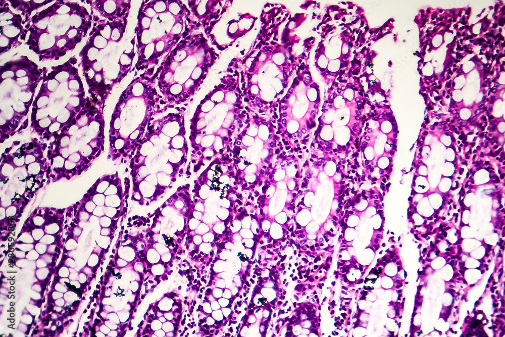 Bacillary dysentery, light micrograph, photo under microscope showing ...
