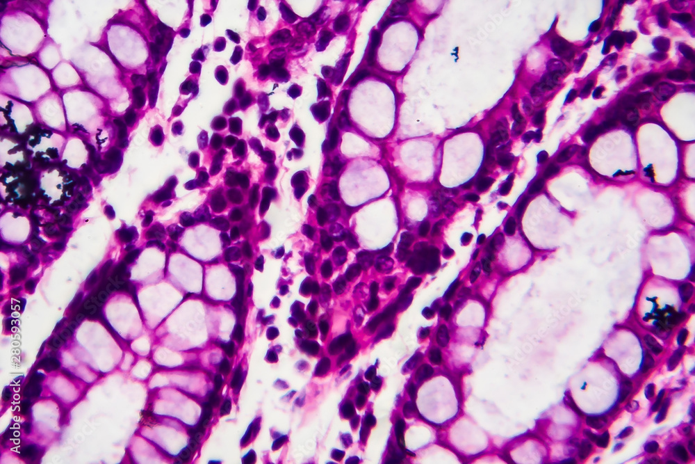 Bacillary dysentery, light micrograph, photo under microscope showing ...