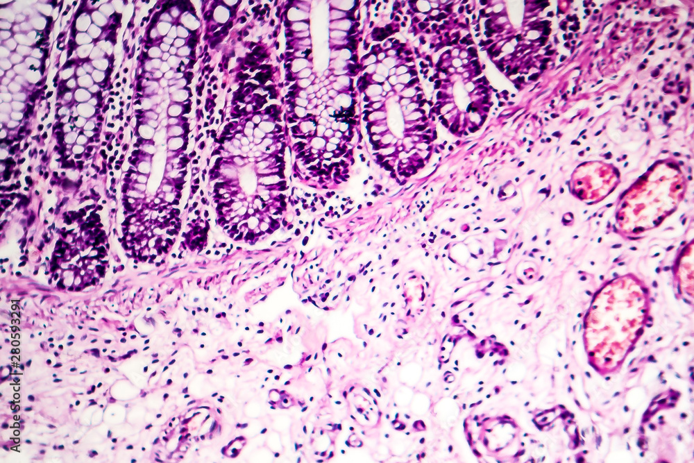 Bacillary dysentery, light micrograph, photo under microscope showing ...