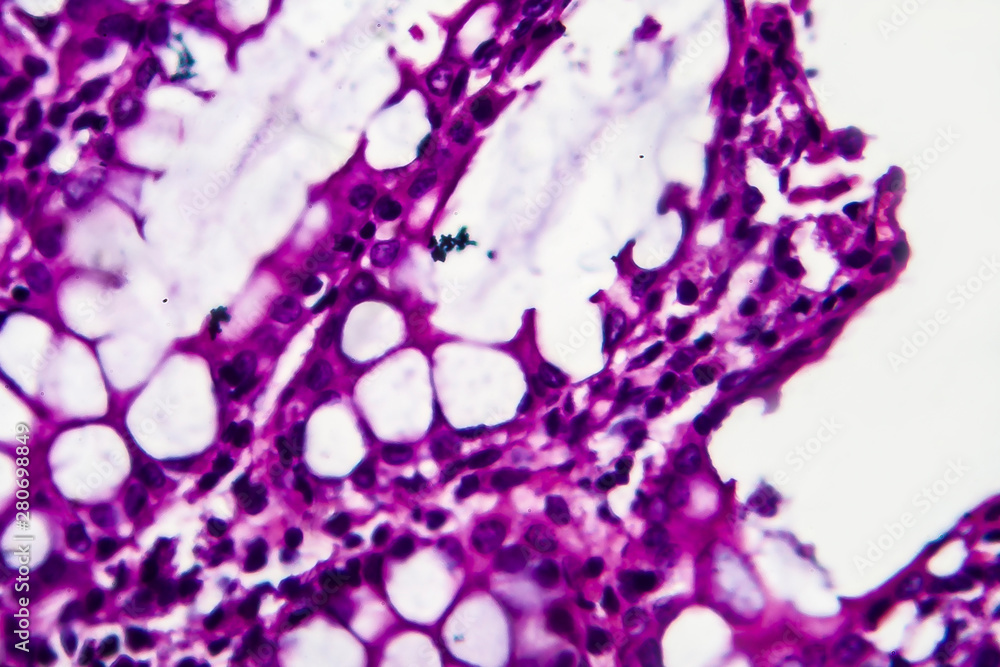 Bacillary dysentery, light micrograph, photo under microscope showing ...