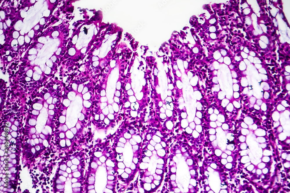 Bacillary dysentery, light micrograph, photo under microscope showing ...