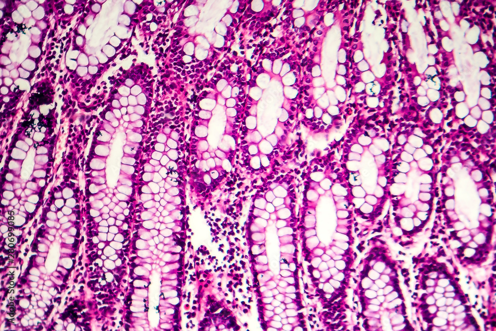 Bacillary dysentery, light micrograph, photo under microscope showing ...