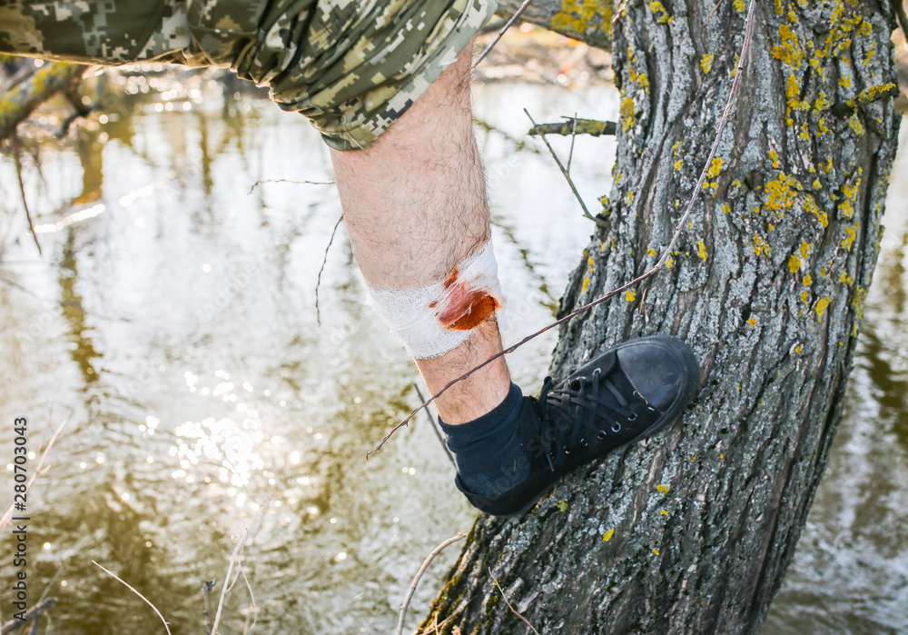 Man is putting bandage on bleeding wound. Injured leg. Tourist in the ...