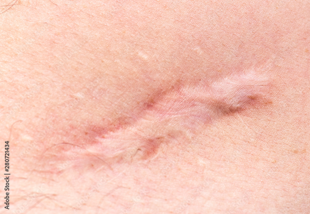 Scar on human skin scar or cicatrice after operation on stomach Stock ...