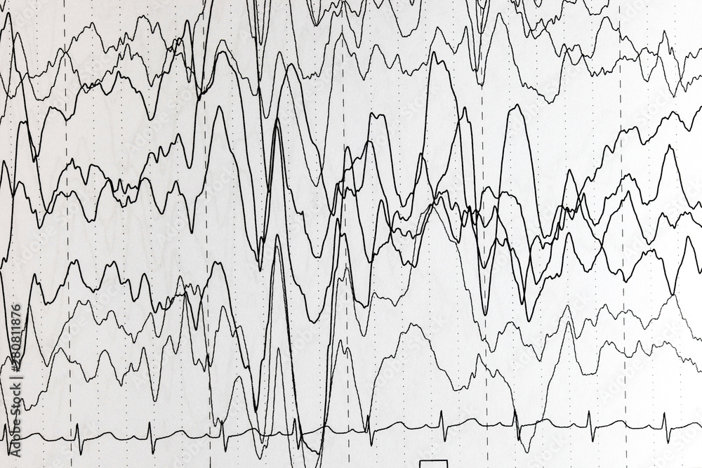 Brain wave patterns on electroencephalogram, EEG of the pediatric ...