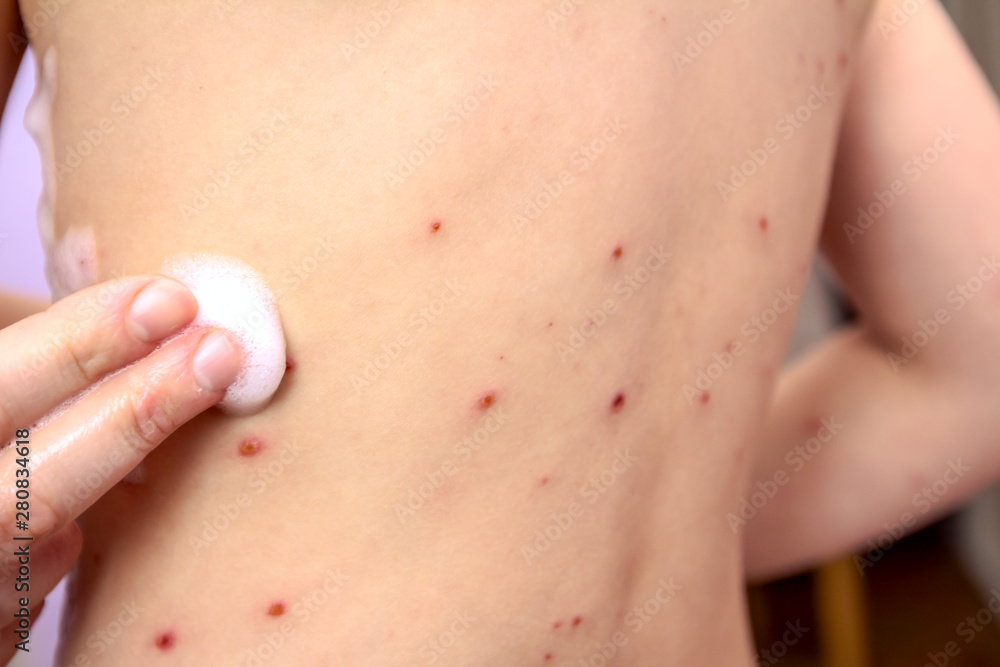 Therapy against the virus of Varicella has measles, chicken pox ...