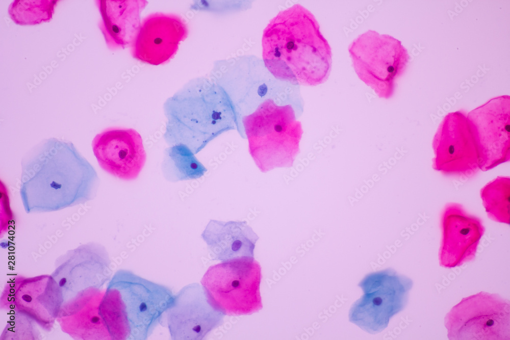 View in microscopic of abnormal human cervix cells.Squamous epithelium ...