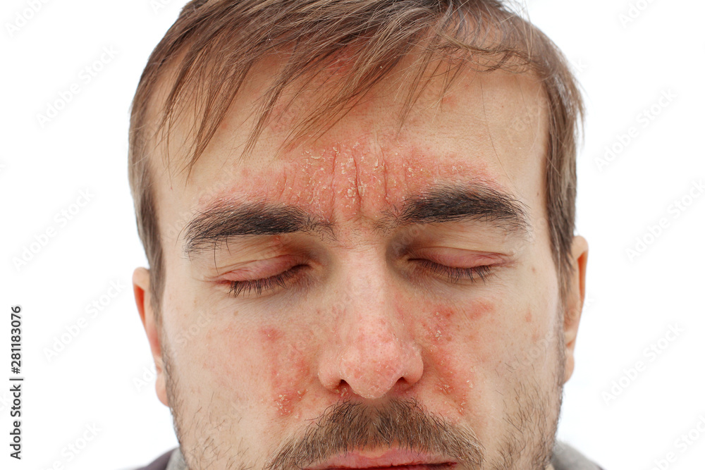 head of sick man with closed eyes with red allergic reaction on facial ...