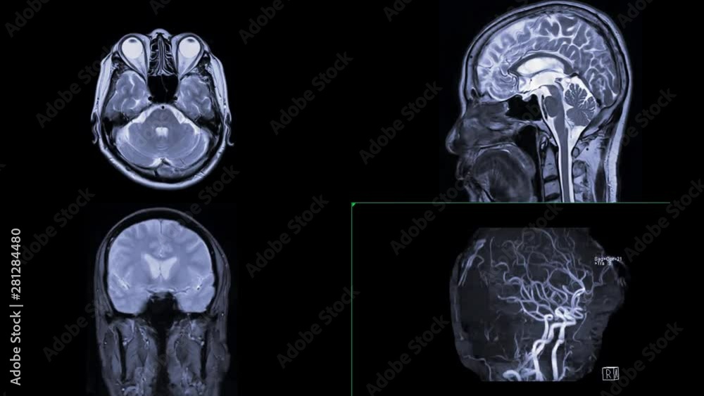 Comparison of MRI MRA brain for detect Brain disease. Stock Video ...