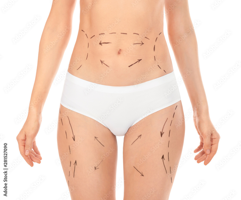 Woman With Marks On Body For Cosmetic Surgery Operation Against White woman-with-marks-on-body-for-cosmetic-surgery-operation-against-white